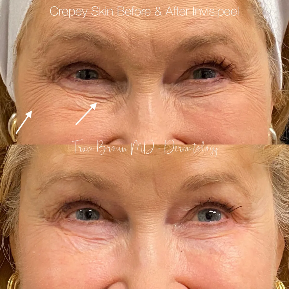 Crepey Skin Treatment | Tricia Brown MD - Dermatology