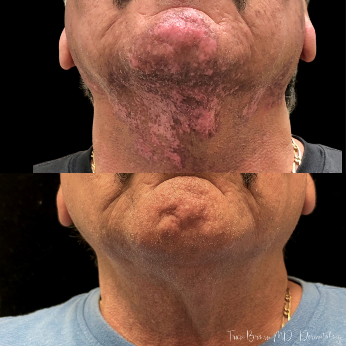 Vitiligo | Tricia Brown MD - Dermatology